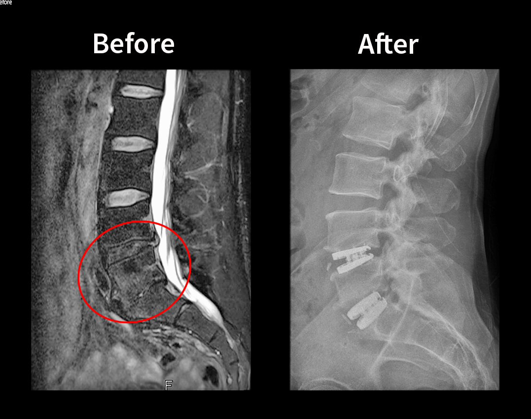 Life-changing Spine Surgery with Dr. Bierstedt in Germany (Actual ...