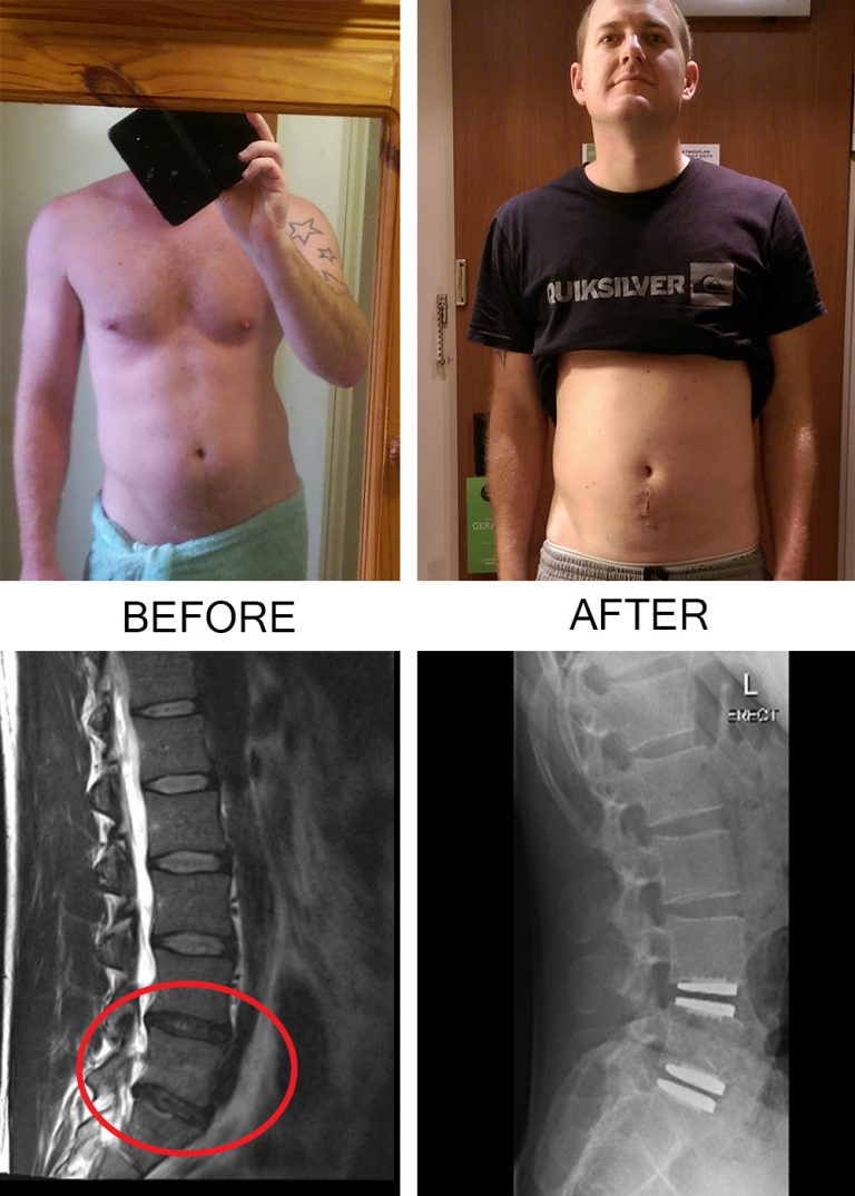 Craig’s Journey with M6 Artificial Disc Replacement in Germany - Spine ...