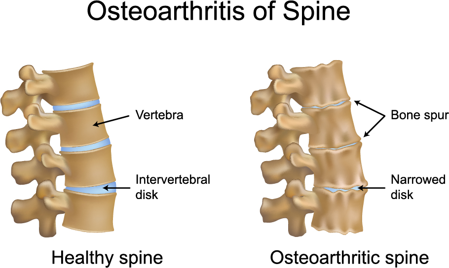 Osteoarthritis Causes Symptoms Treatments
