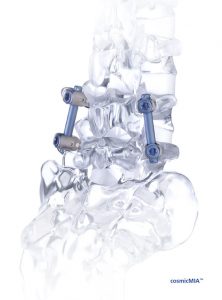 Dynamic Stabilization System (DSS) Creates Flexible Stability for Spine ...